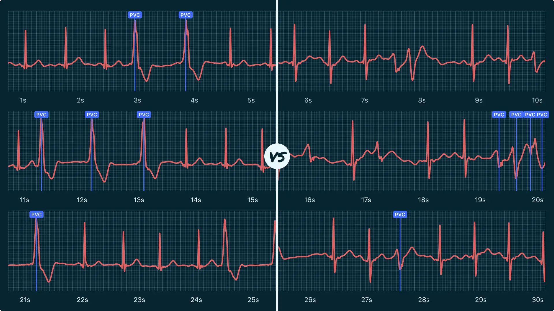 Accelerated Idioventricular Rhythm vs Ventricular Tachycardia on Your Watch ECG | Qaly
